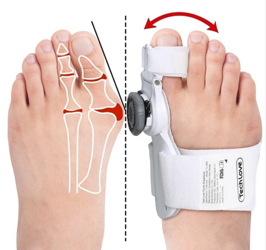 Ortéza na vbočený palec s kloubem - jak zastavit hallux valgus | Ortek